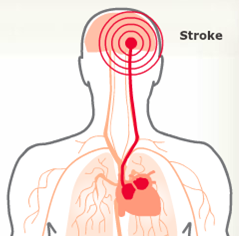 How to Prevent for a Mini-Stroke? – Allendale Acupuncture & Nutrition ...